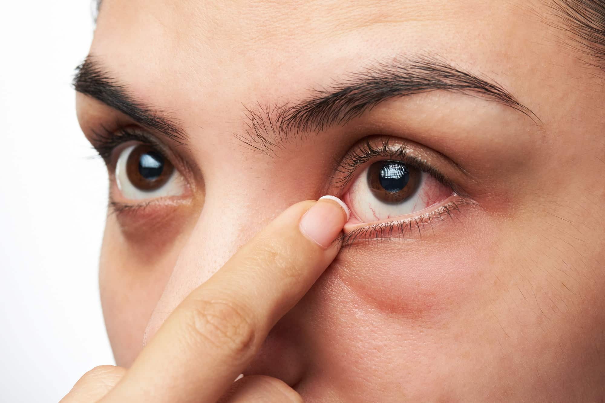 The Causes and Symptoms of Dry Eyes and How to Treat It - Optician in ...